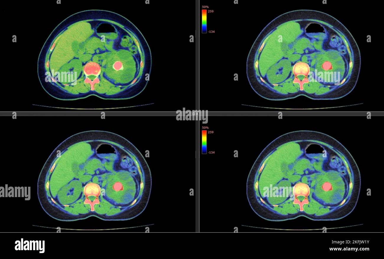 Kidney stone, CT scans Stock Photo - Alamy