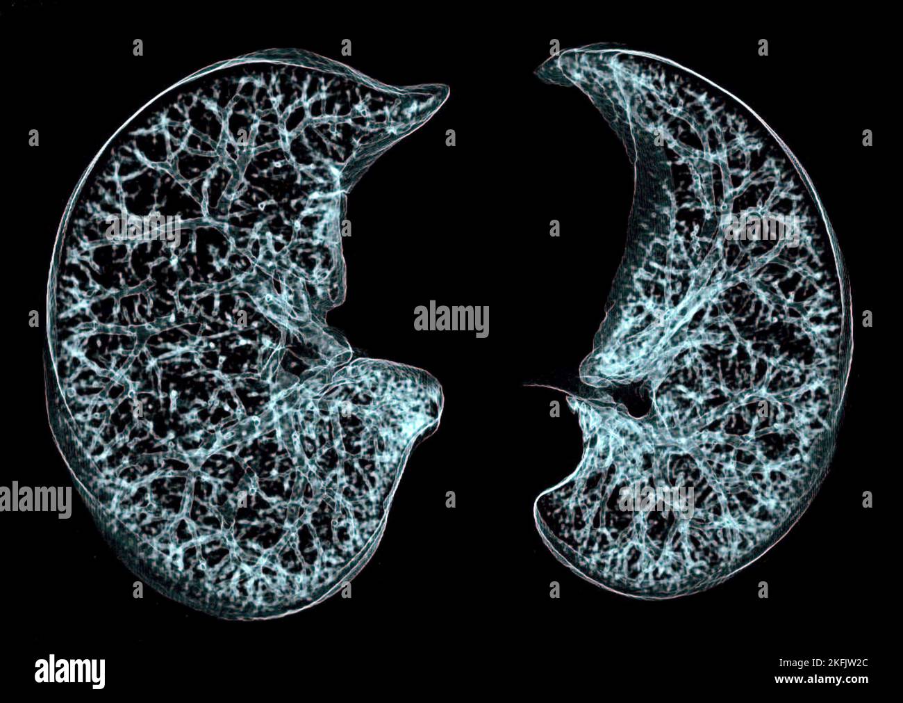 Healthy lungs, 3D CT scan Stock Photo - Alamy