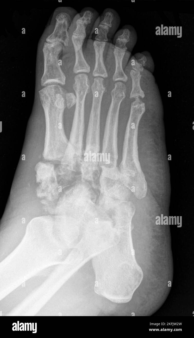 Bone infection, X-ray Stock Photo - Alamy