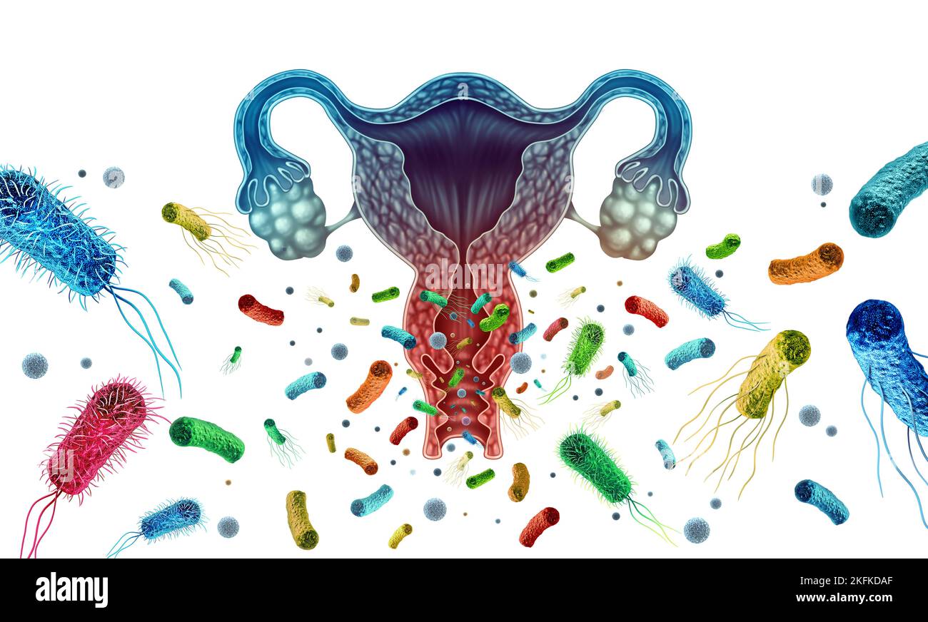 Bacterial Vaginosis Condition As A Vaginal Inflammation Caused By Bacteria Infection In The