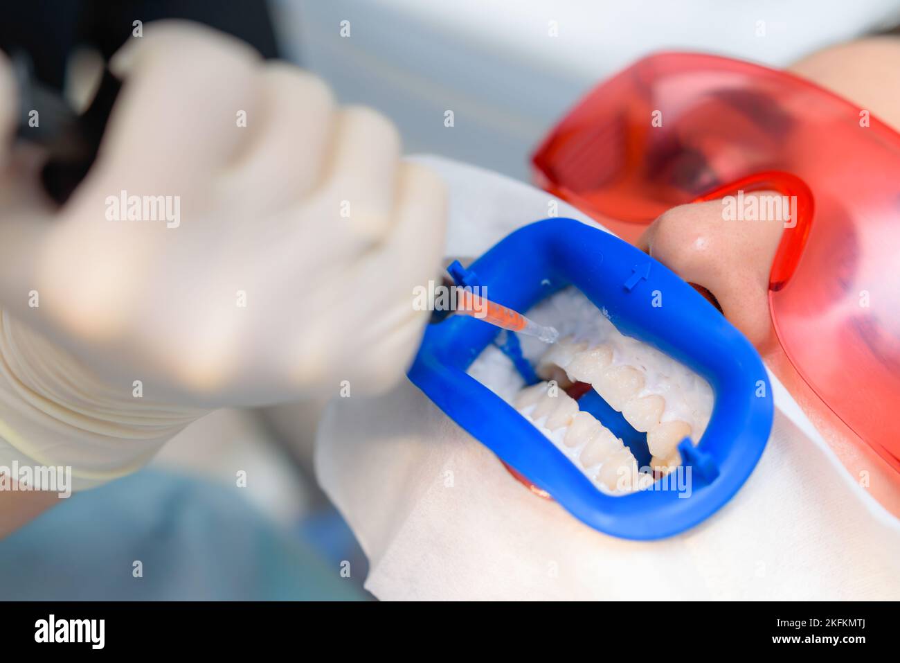 there is a preparation of the oral cavity to bleaching with the help of ...