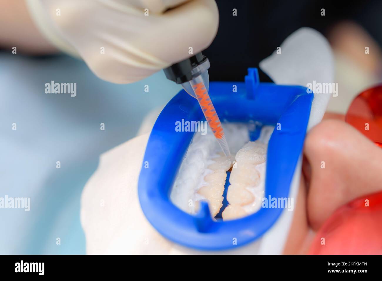 there is a preparation of the oral cavity to bleaching with the help of ...