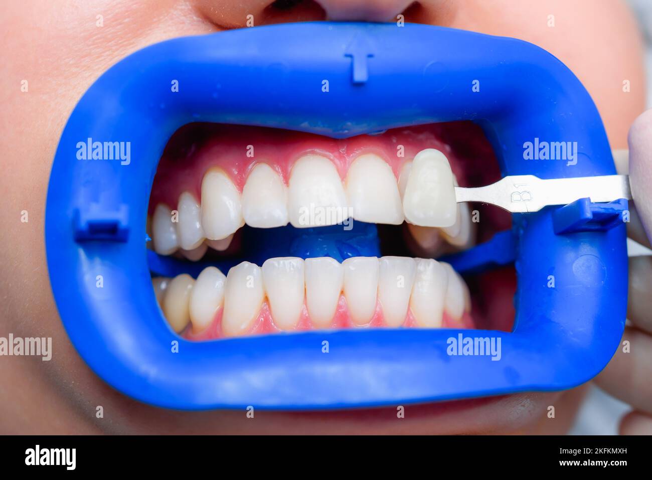 procedure for comparing the color shades of teeth after bleaching Stock ...