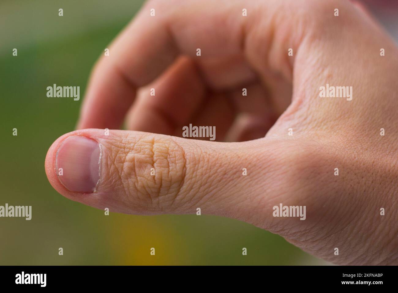 Burn scar hand hi-res stock photography and images - Alamy