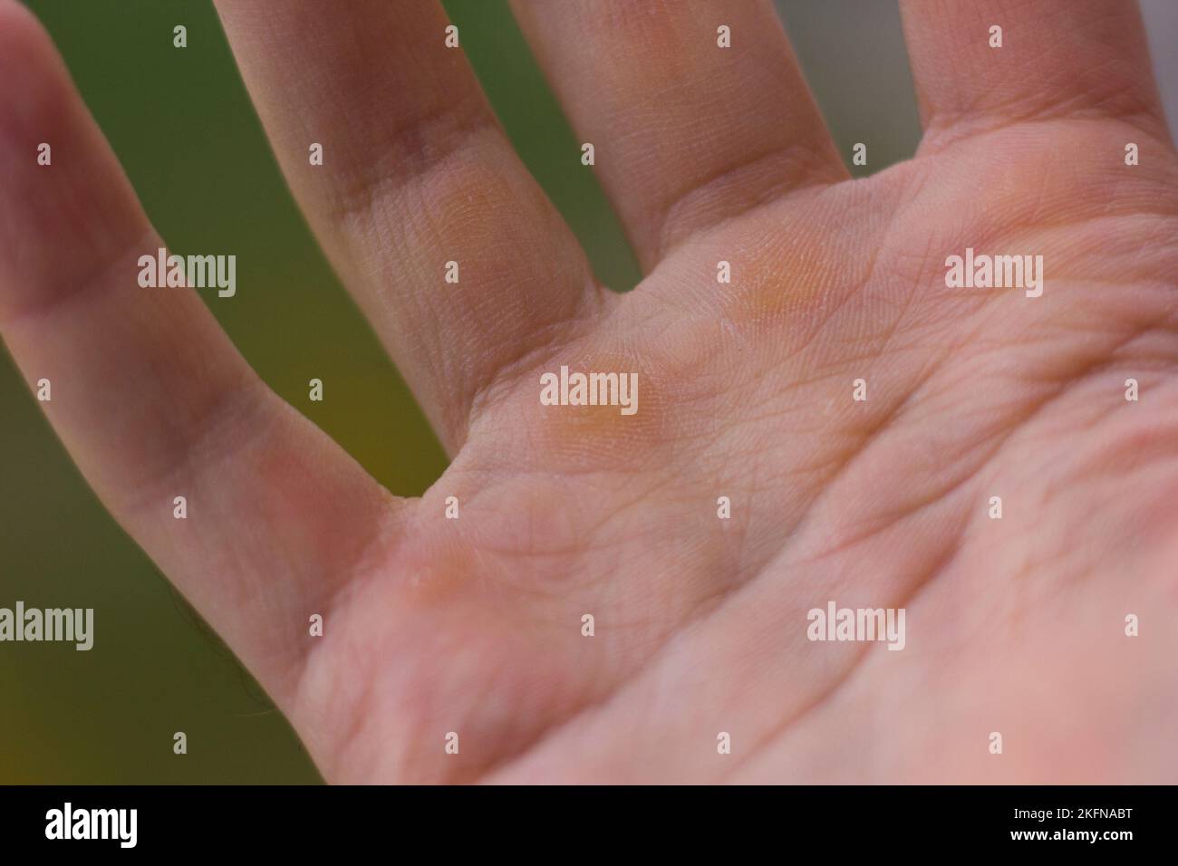 Skin injury hi-res stock photography and images - Alamy