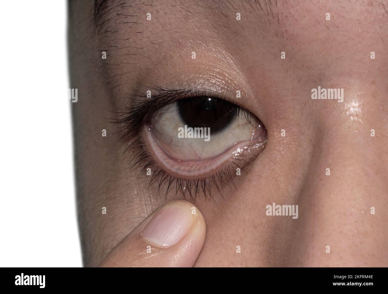 Pale skin of Asian young man. Sign of anemia. Pallor at eyelid Stock ...