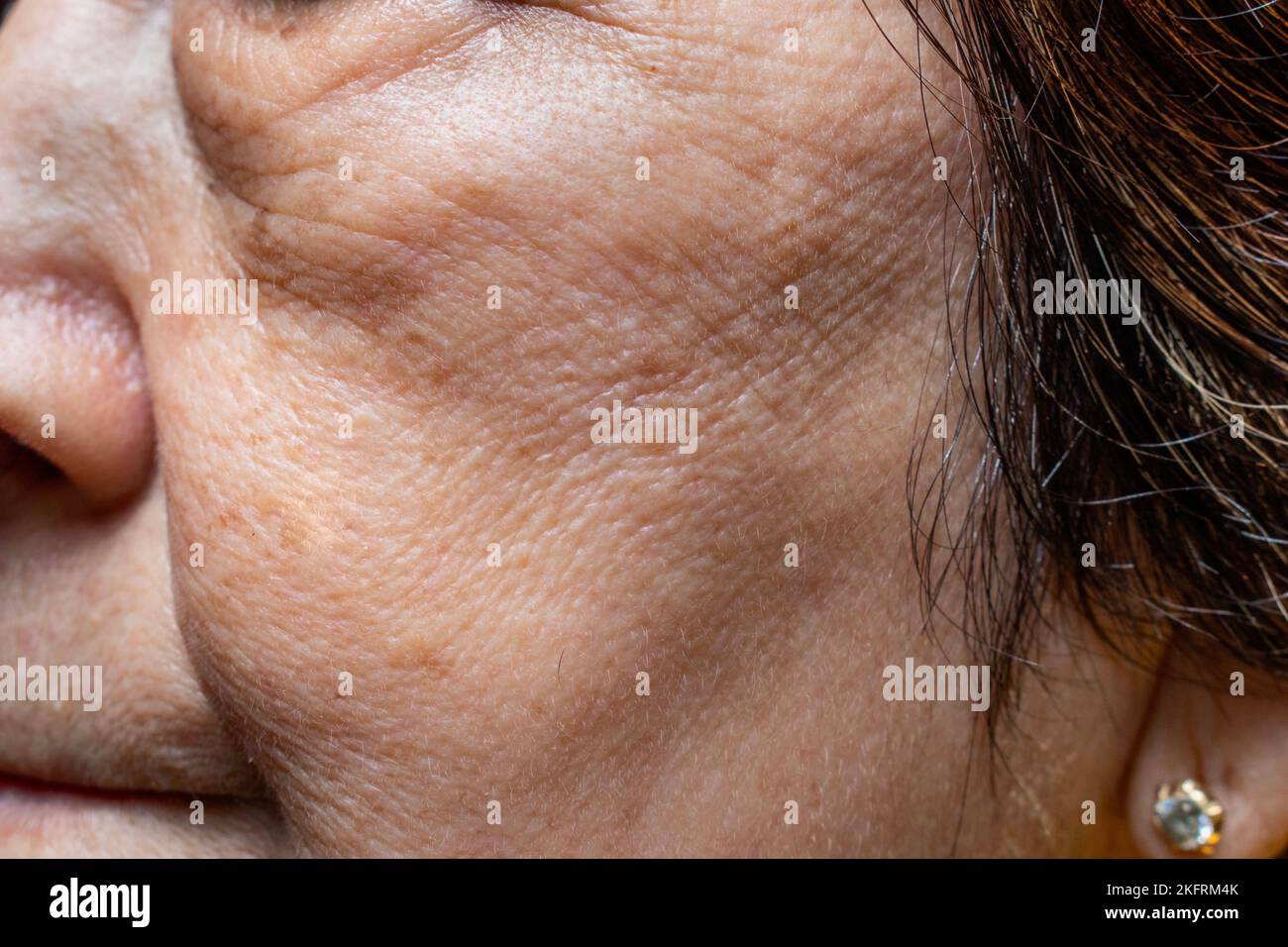 Wrinkles and loosening skin in the face of Southeast Asian, Chinese ...