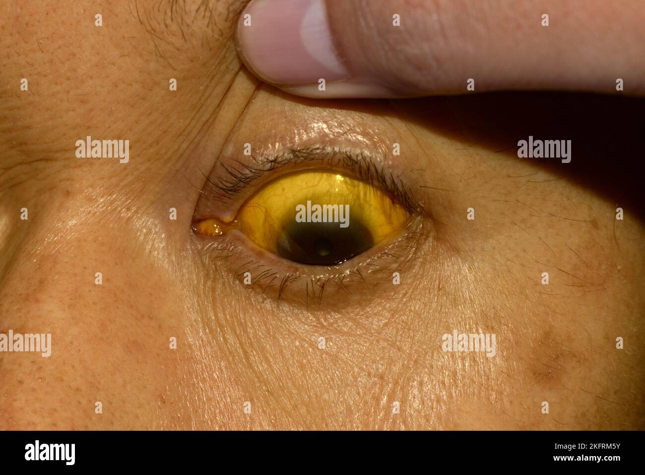 Deep jaundice in Asian male patient. Yellowish discoloration of skin ...