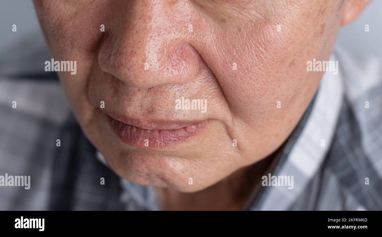 Enlarged pores in face of Southeast Asian, Chinese elder man with skin ...
