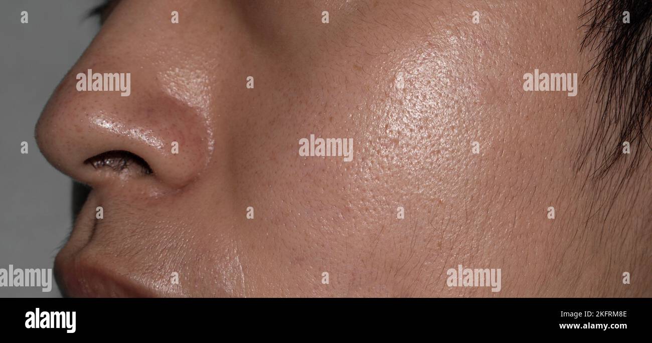 Oily face with wide pores of Southeast Asian, Myanmar or Korean adult ...