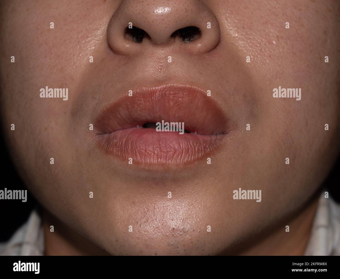 Swollen or thickened upper lip of Asian young man. Angioedema. Causes ...