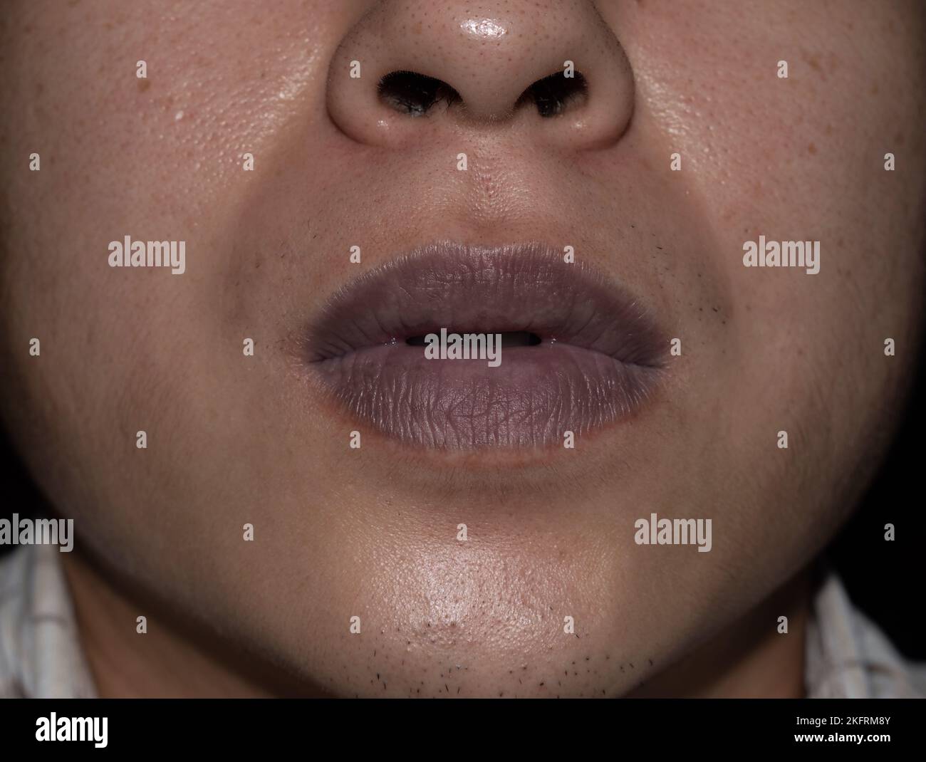 Central cyanosis in the lips of Southeast Asian young man with ...