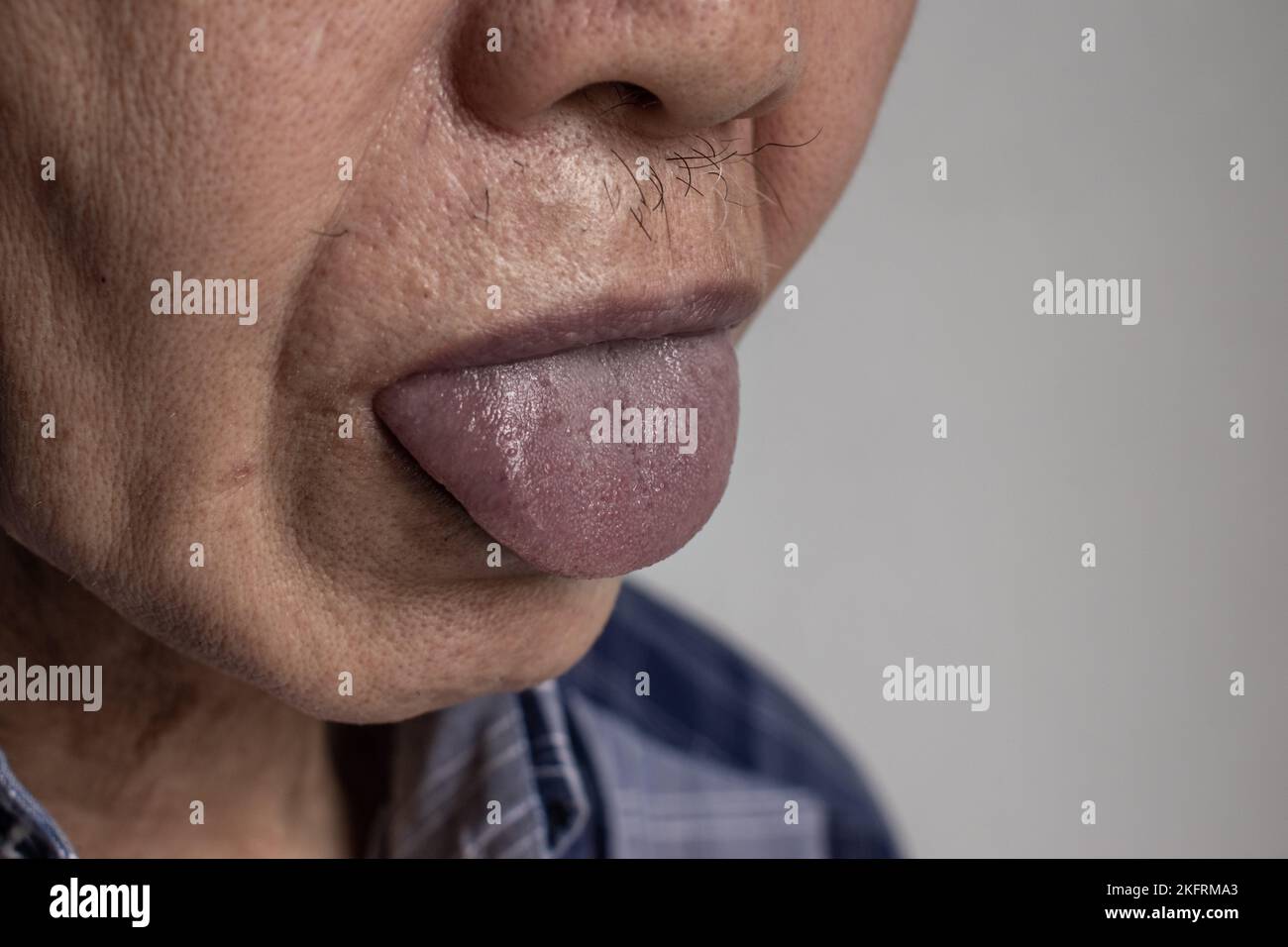 Central cyanosis in Southeast Asian old man with congenital heart ...