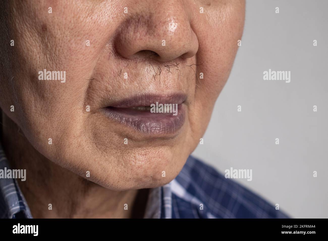 Central Cyanosis In Southeast Asian Old Man With Congenital Heart