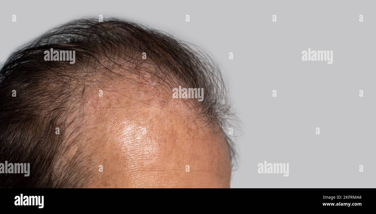 Bald head of Asian elder man. Concept of male pattern hair loss or ...