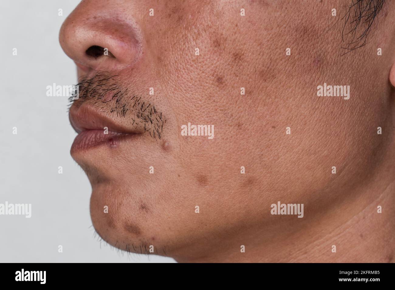 Small brown patches called age spots and scars on the face of Asian man ...