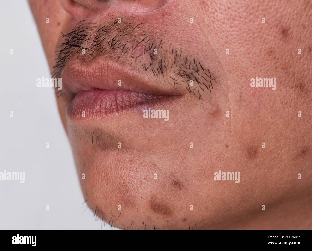 Sun spots face hi-res stock photography and images - Alamy