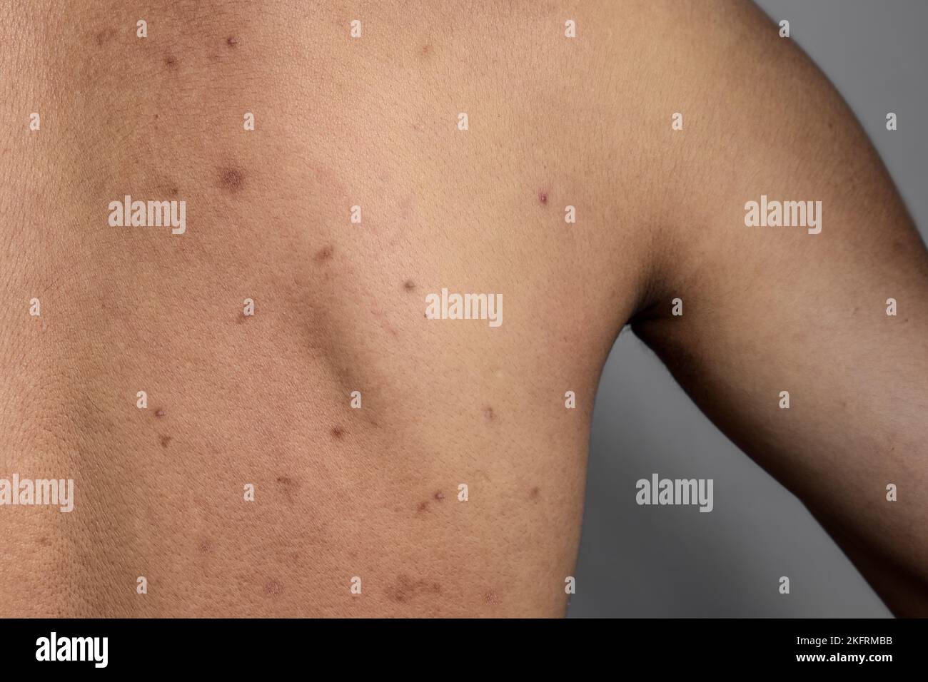 Black spots, pimples, acne and scars on the back of Asian, Myanmar man ...