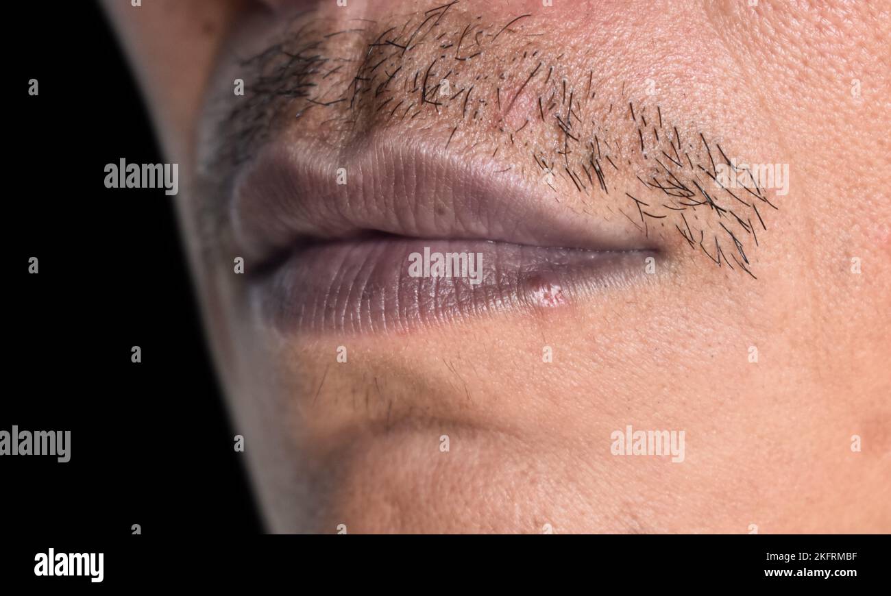 Central cyanosis in Southeast Asian young man with congenital heart ...
