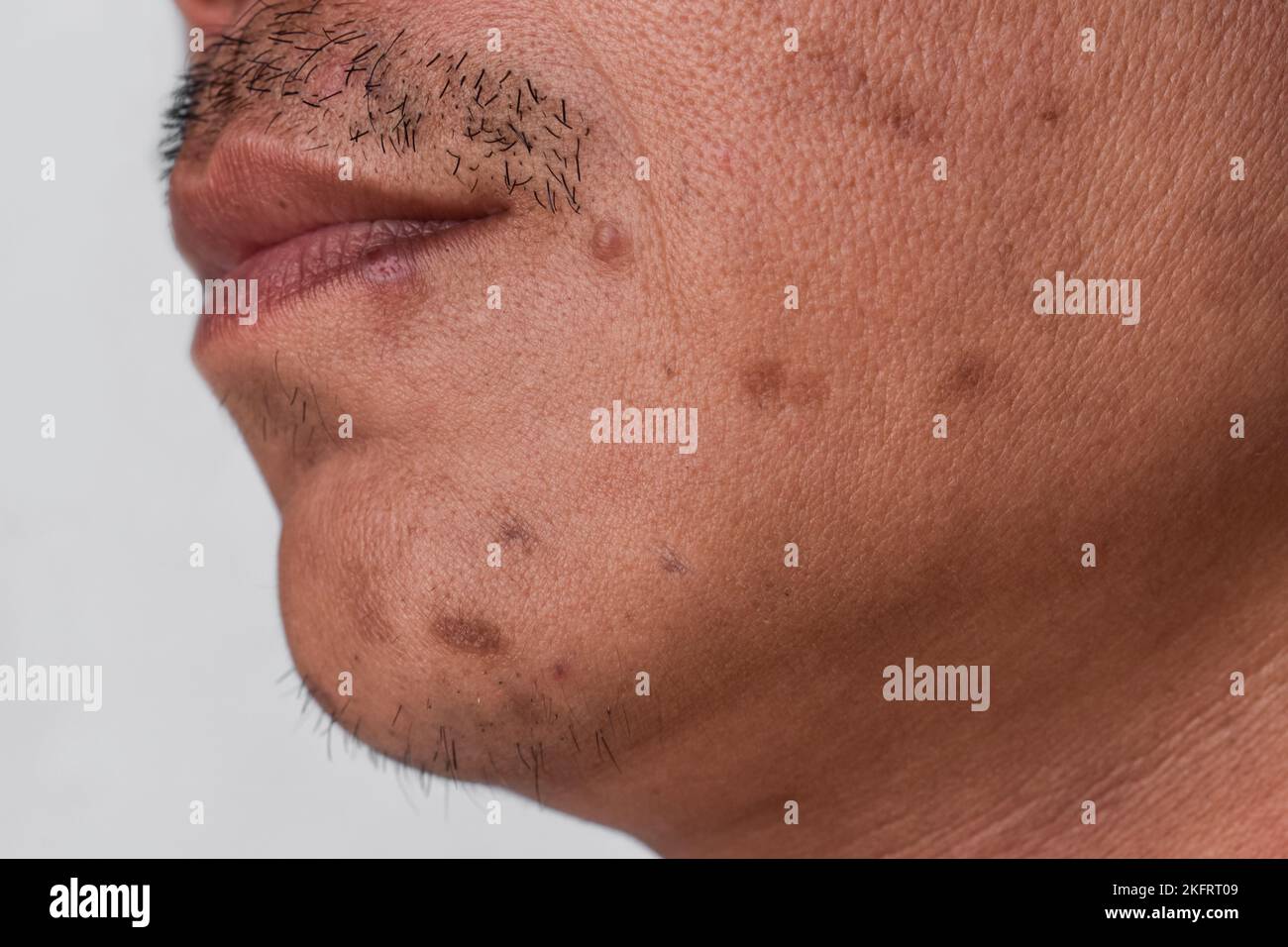 Small brown patches called age spots and scars on the face of Asian man ...