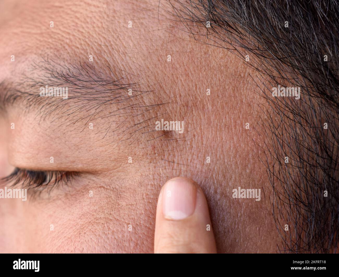 Scarification Before And After Face