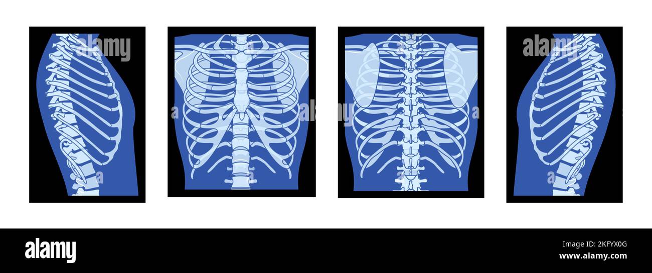 Set of X-Ray Rib cage Skeleton Human body - chest, vertebra, Bones ...