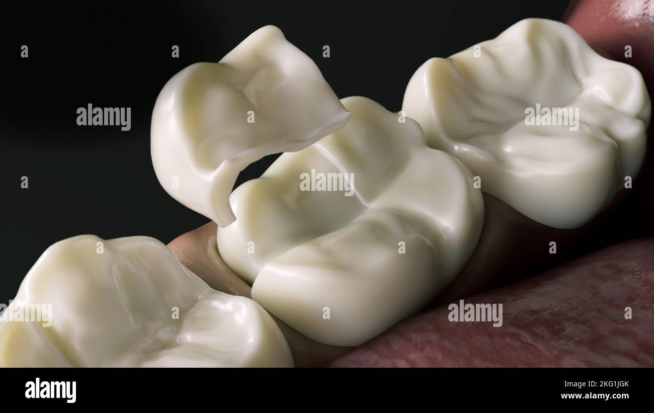 Ceramic Onlay quarter crown over a tooth- 3D Rendering Stock Photo - Alamy