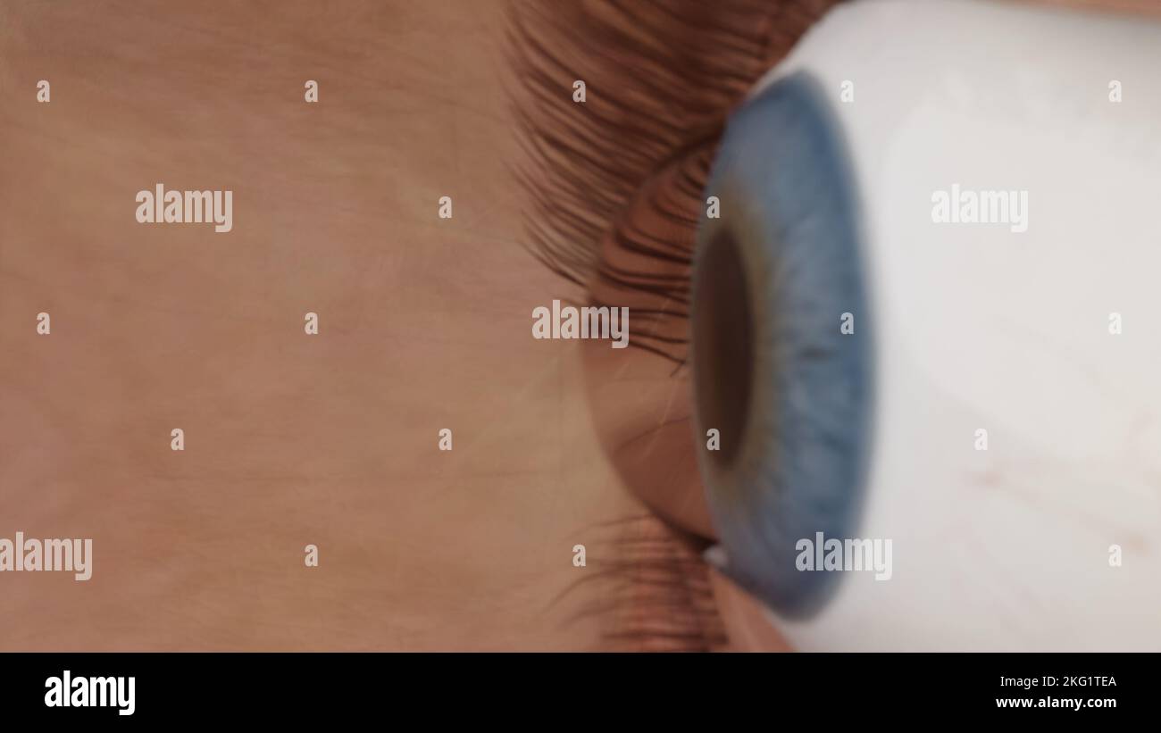 Render Keratoconus eye. Curvature of the cornea in the form of a cone ...