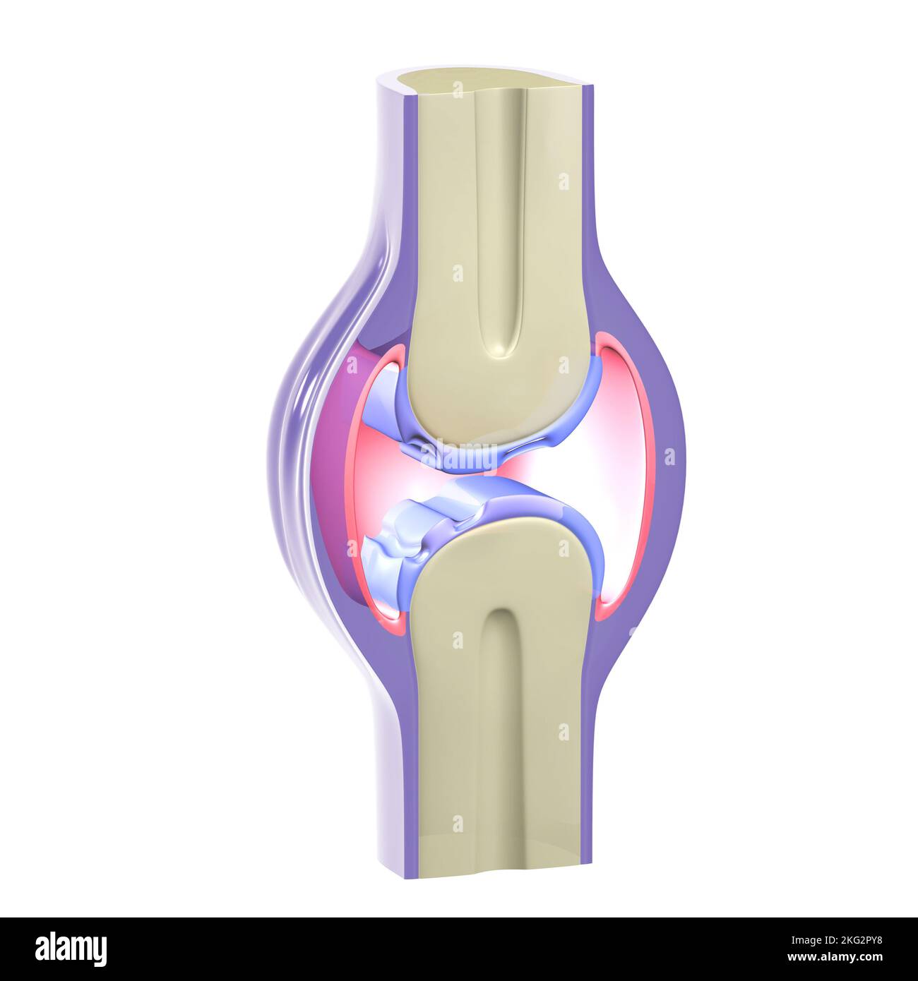 3D illustration of a synovial joint with osteoarthritis. Graphic ...