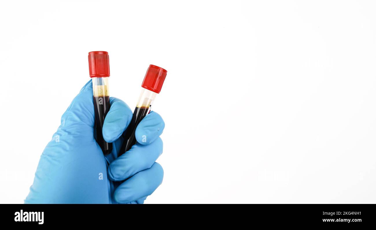 A blood test sample tube with a red cap is in the hand of a blue gloved ...