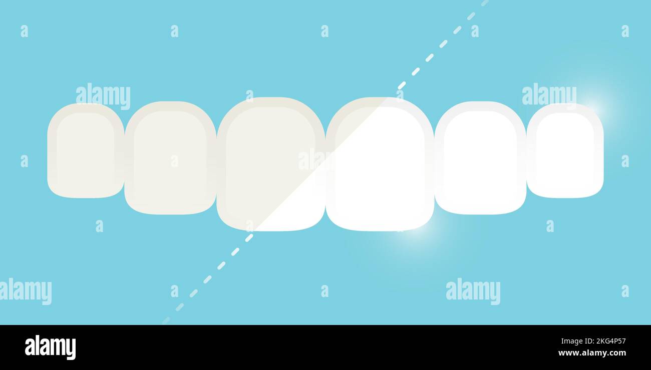 Teeth whitening. Before and after. Dental concepts. Vector illustration ... Teeth whitening. Before and after. Dental concepts. Vector illustration ...