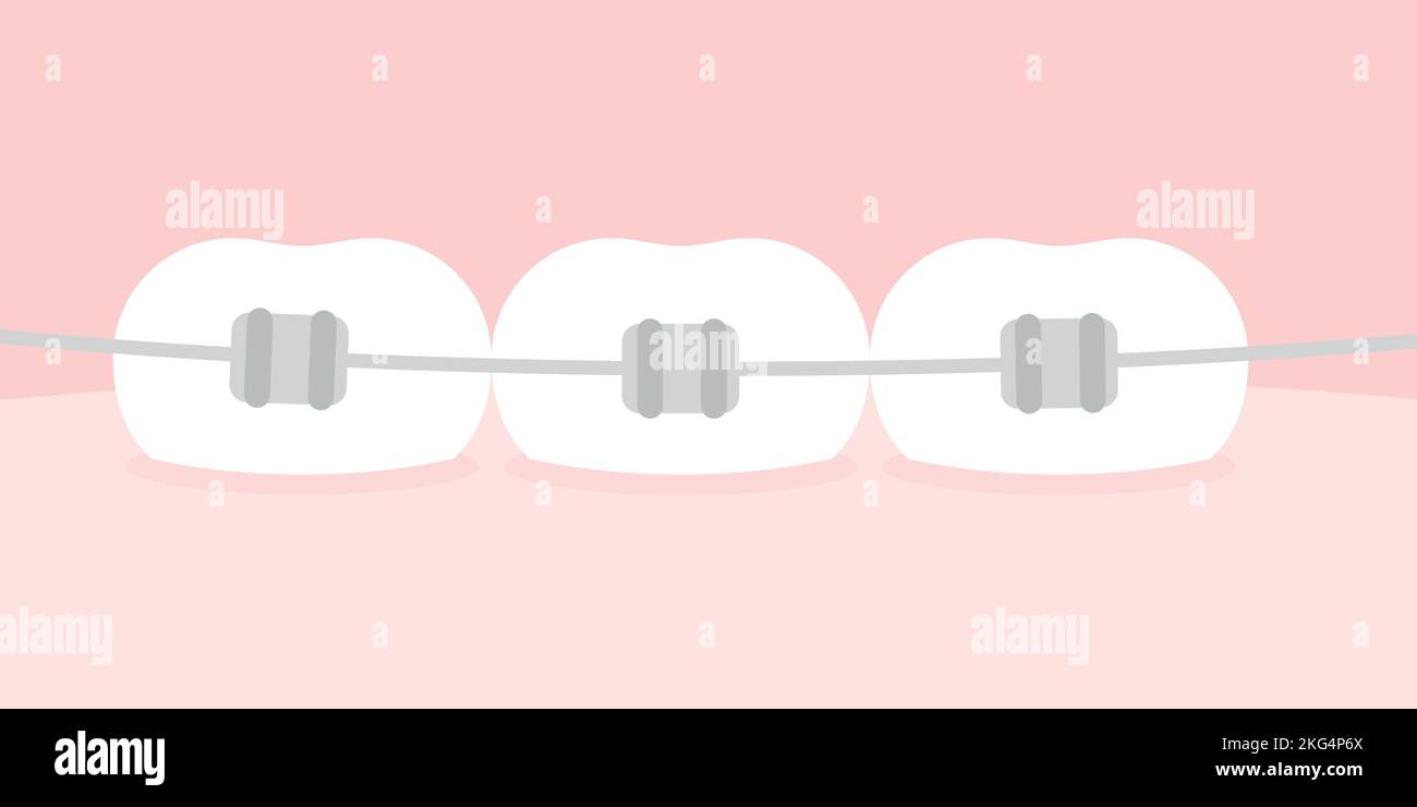 Teeth braces. Concept of orthodontics. Horizontal format. Vector ...