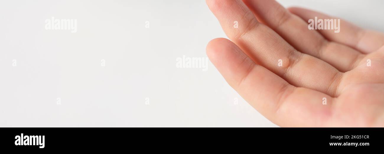 Wart on the finger. Close-up of a wart on a child's finger. The common ...