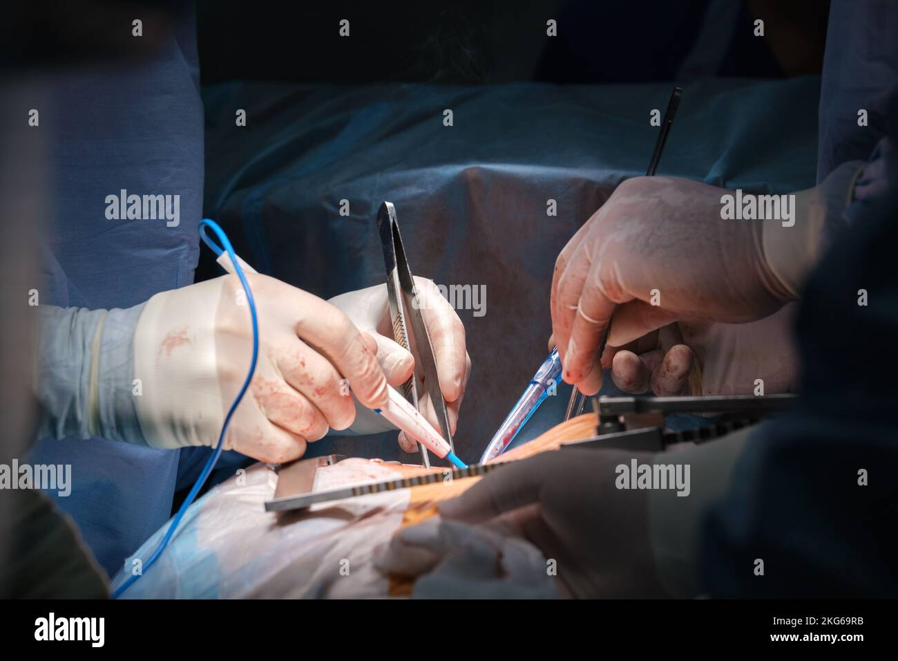 Closeup of professional doctor hands operating a patient during open ...
