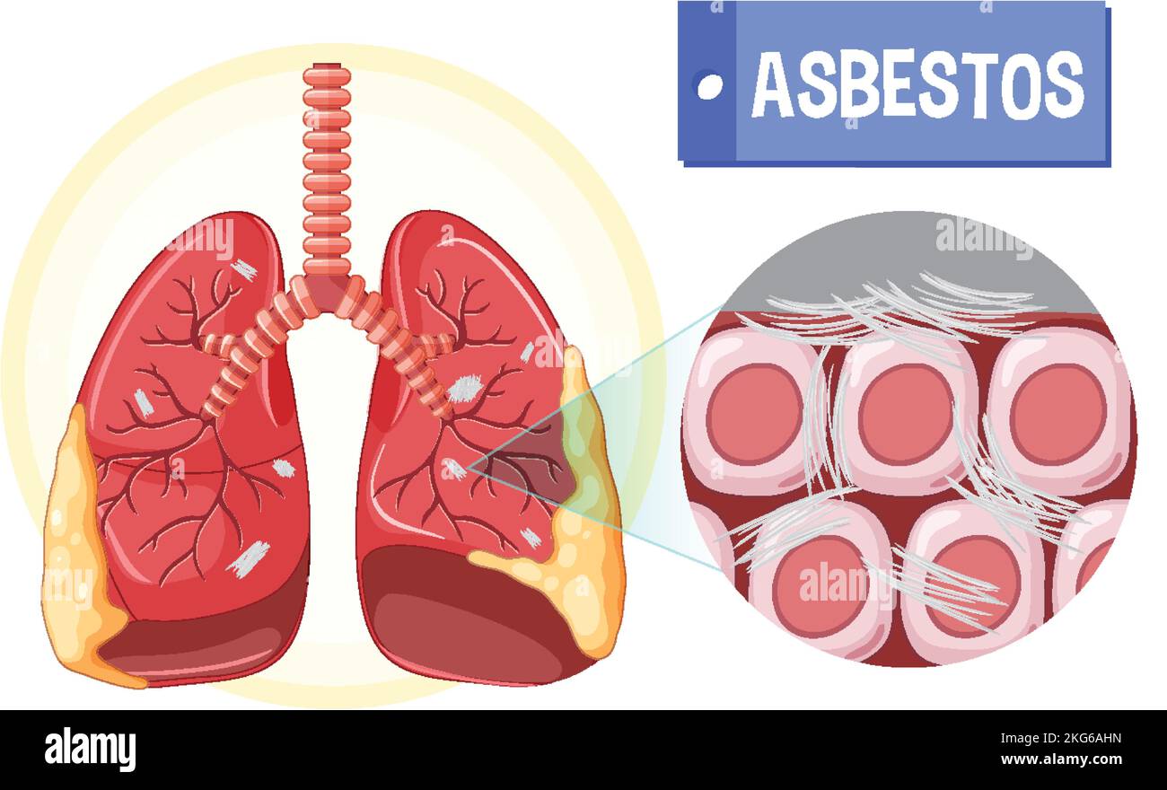Diagram showing asbestosis in lungs illustration Stock Vector Image ...