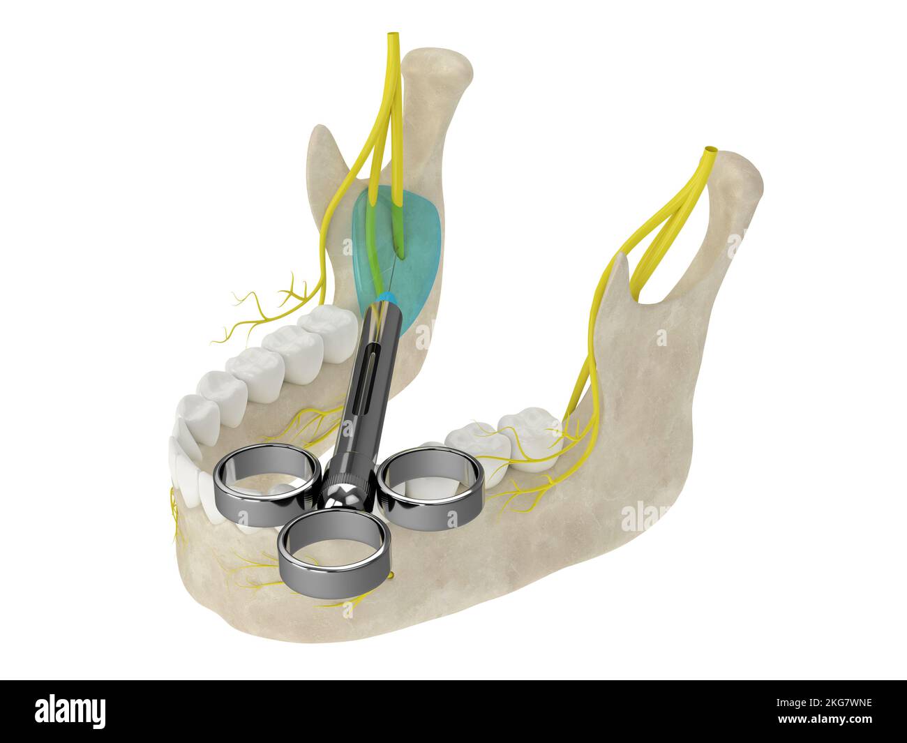 3d Render Of Mandibular Arch With Inferior Alveolar Nerve Block Types