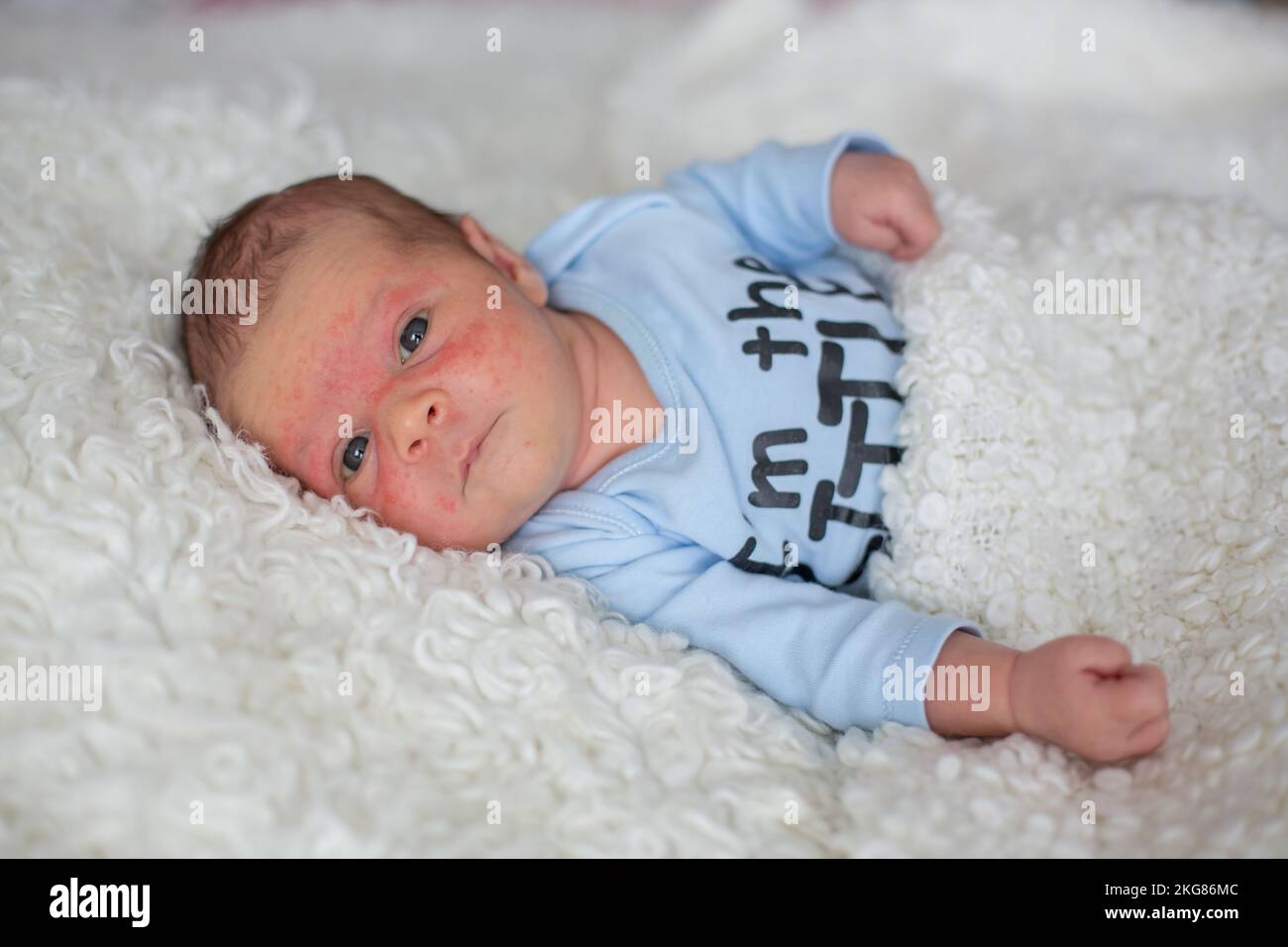 Little newborn baby looking, baby with skin rash, child dermatitis ...