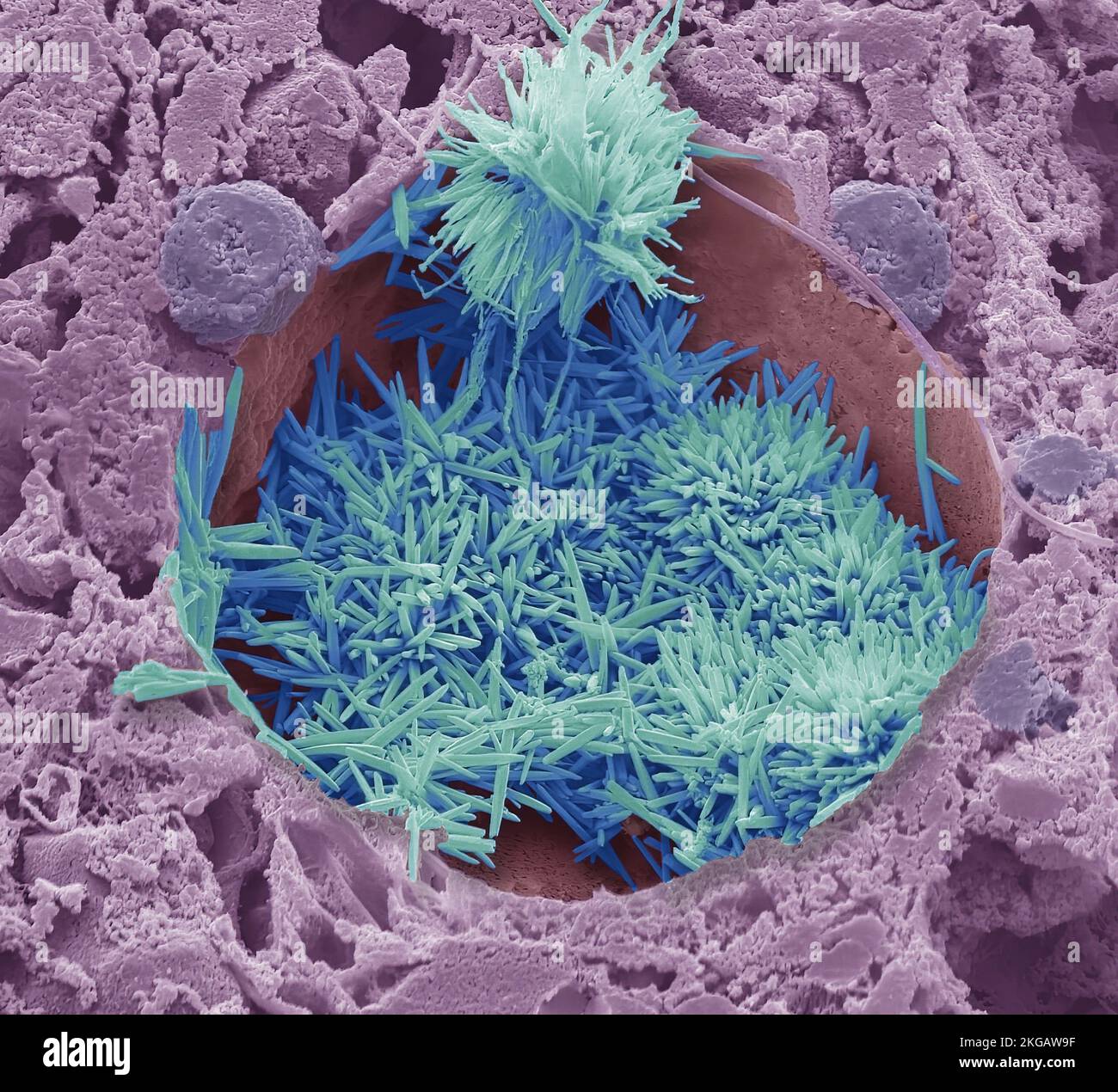 Coloured scanning electron micrograph (SEM) of cholesterol crystals ...