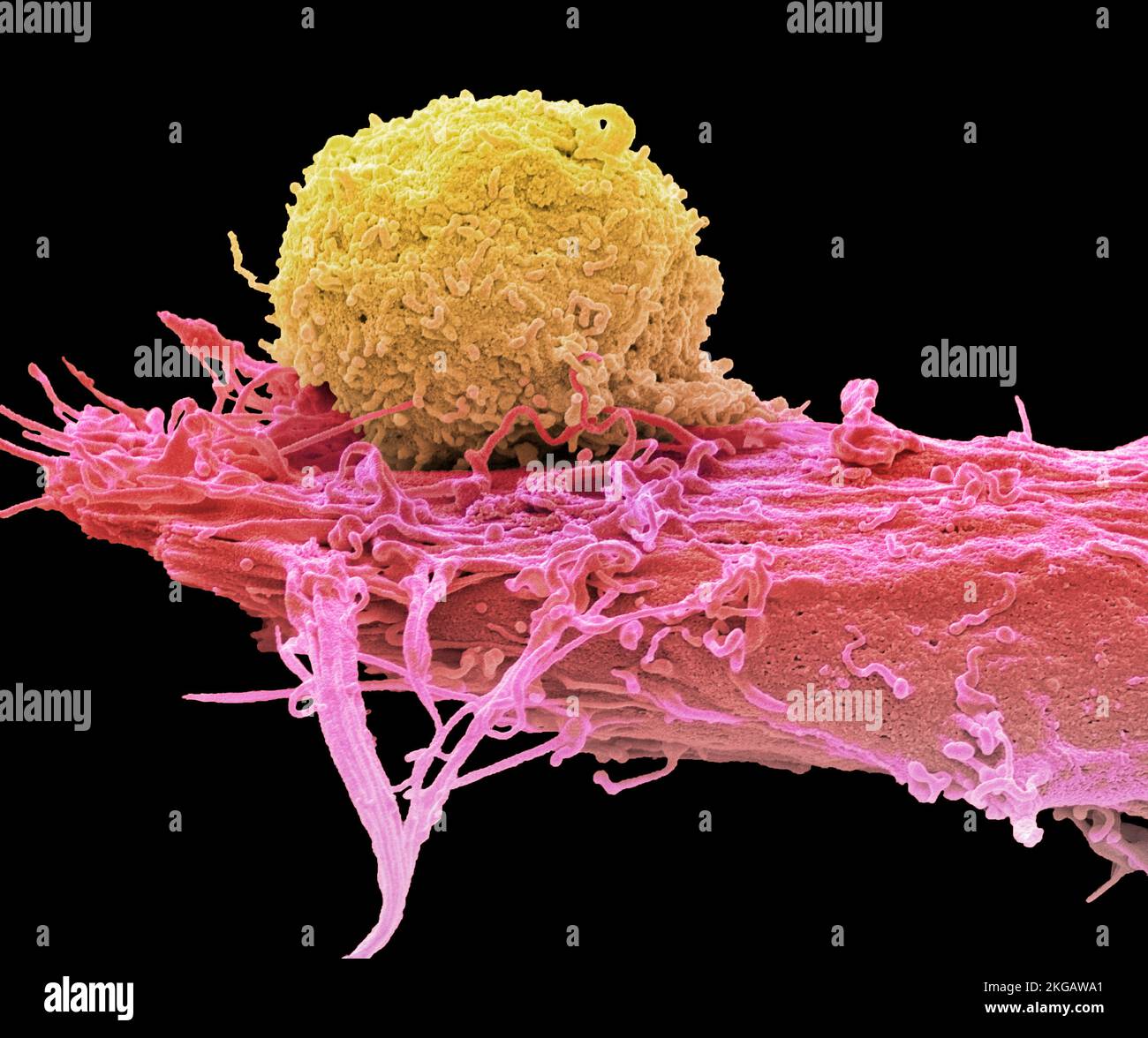 CAR T-cell therapy. Coloured scanning electron micrograph (SEM) of a T ...