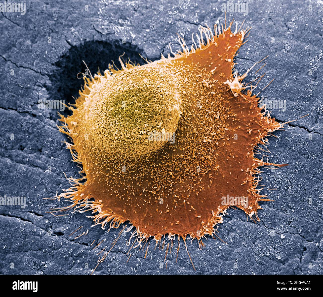 Bone cancer. Coloured scanning electron micrograph (SEM) of a cancerous ...