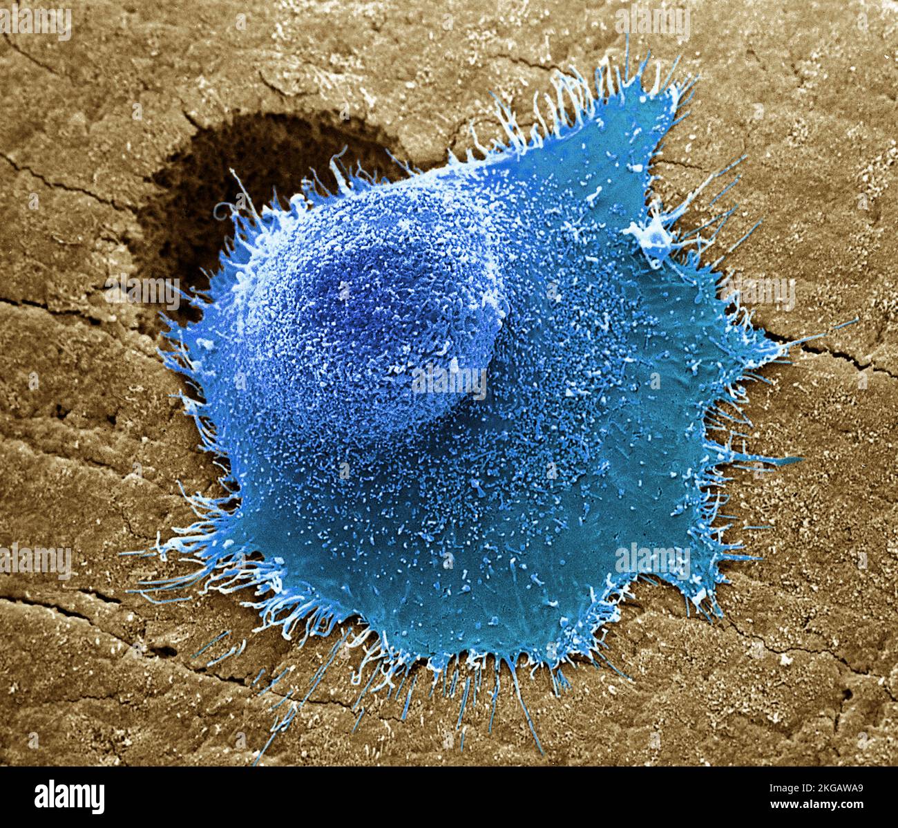 Bone cancer. Coloured scanning electron micrograph (SEM) of a cancerous ...