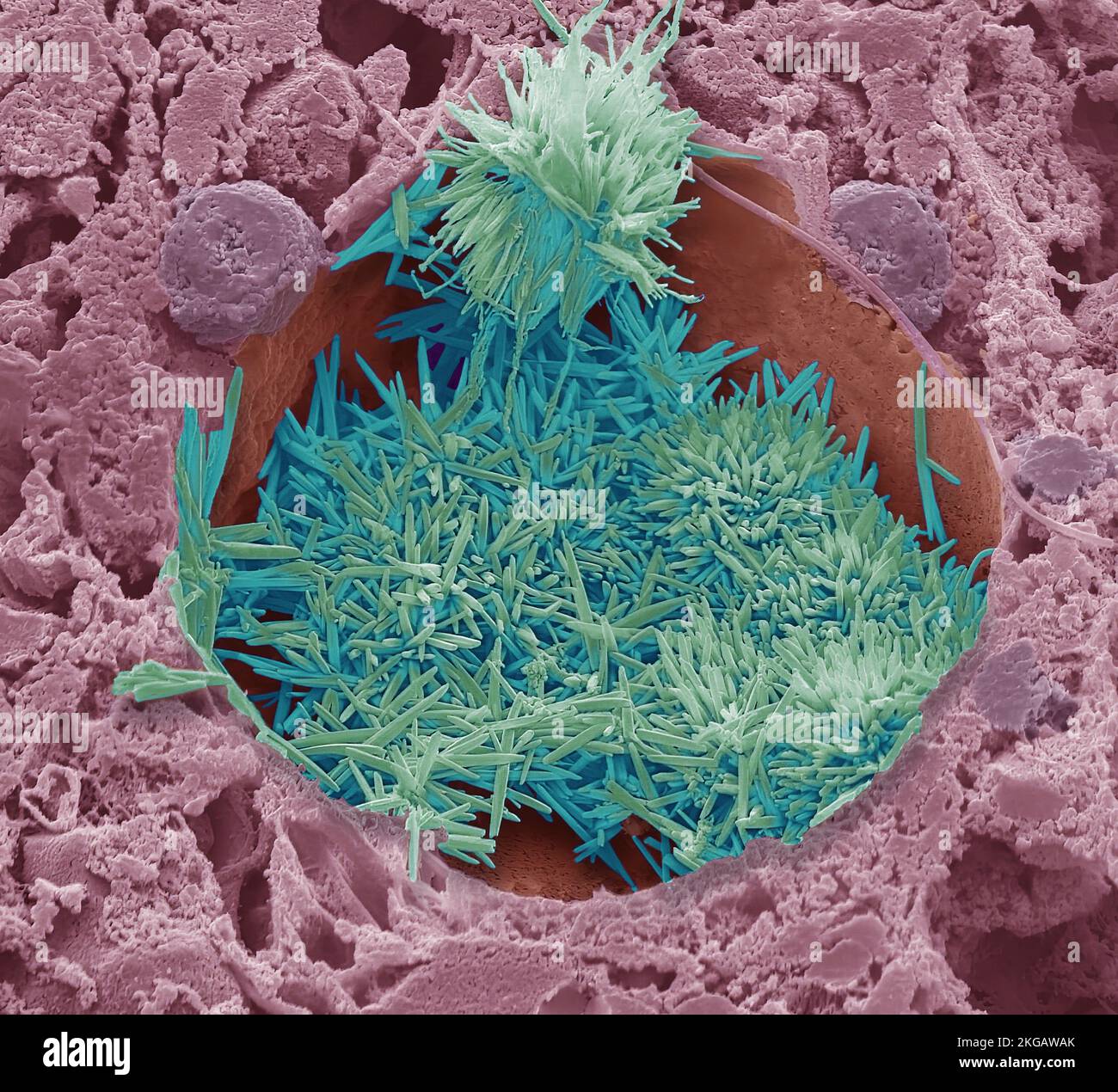 Coloured scanning electron micrograph (SEM) of cholesterol crystals ...