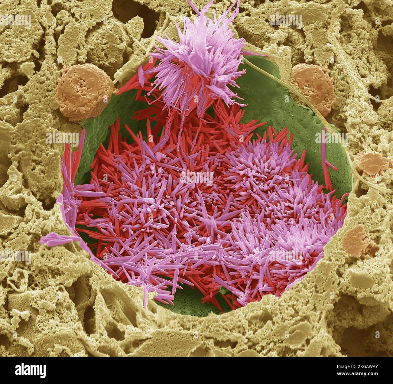 Coloured scanning electron micrograph (SEM) of cholesterol crystals ...