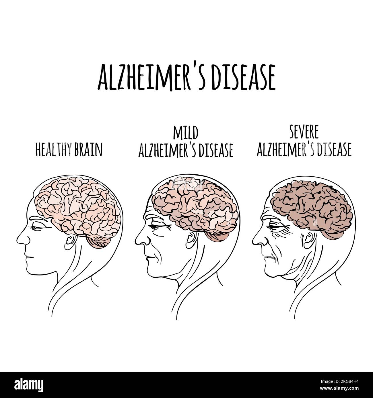 DEMENTIA Alzheimer Disease Memory Loss Brain Damage Medicine Health ...