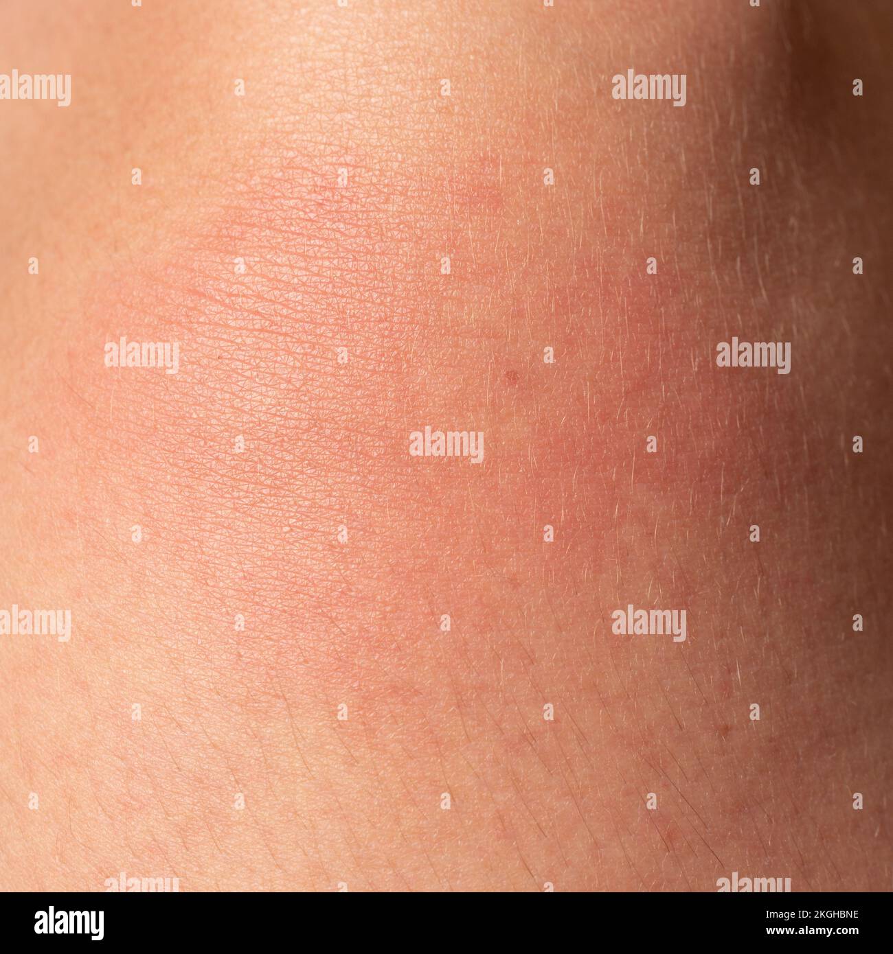 Allergy on human body and redness from wasp sting, redness and sting ...