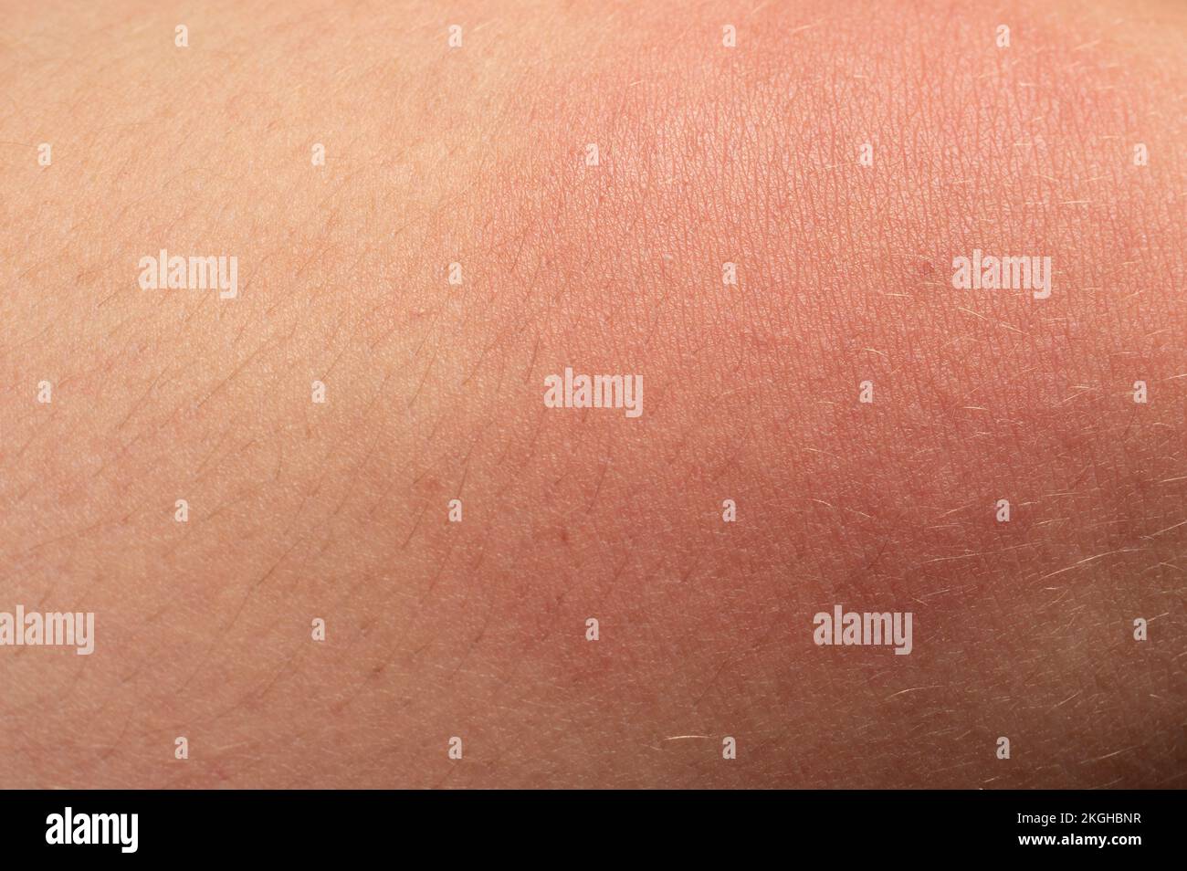 Allergy on human body and redness from wasp sting, redness and sting ...