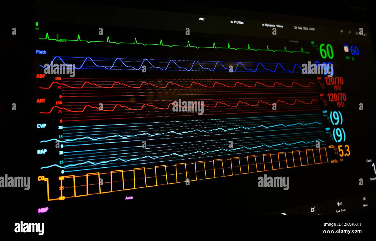 Screen of a bedside patient monitor in an English hospital Stock Photo ...