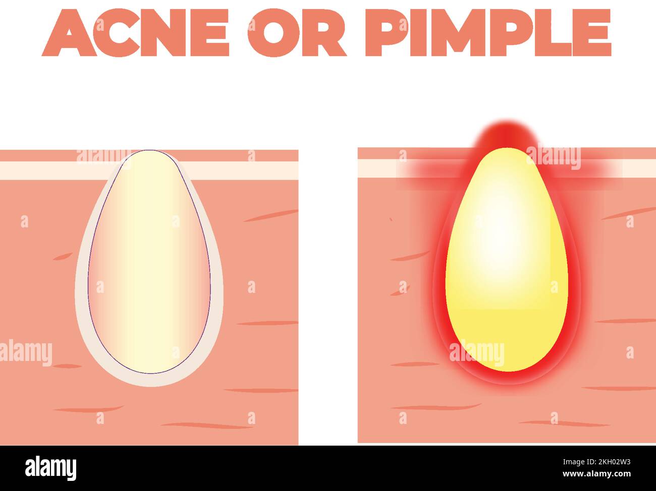 Pimple on skin infection Stock Vector Images - Alamy