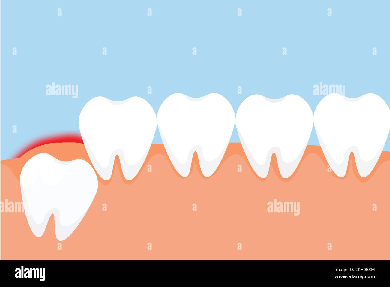 A wisdom tooth erupts through the gum and gives a red pain signal ...
