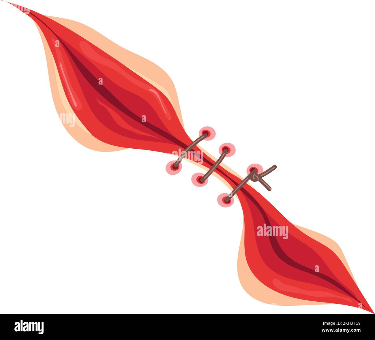 Skin cut wound with surgical stitches. Red mark isolated on white background Stock Vector Image ...